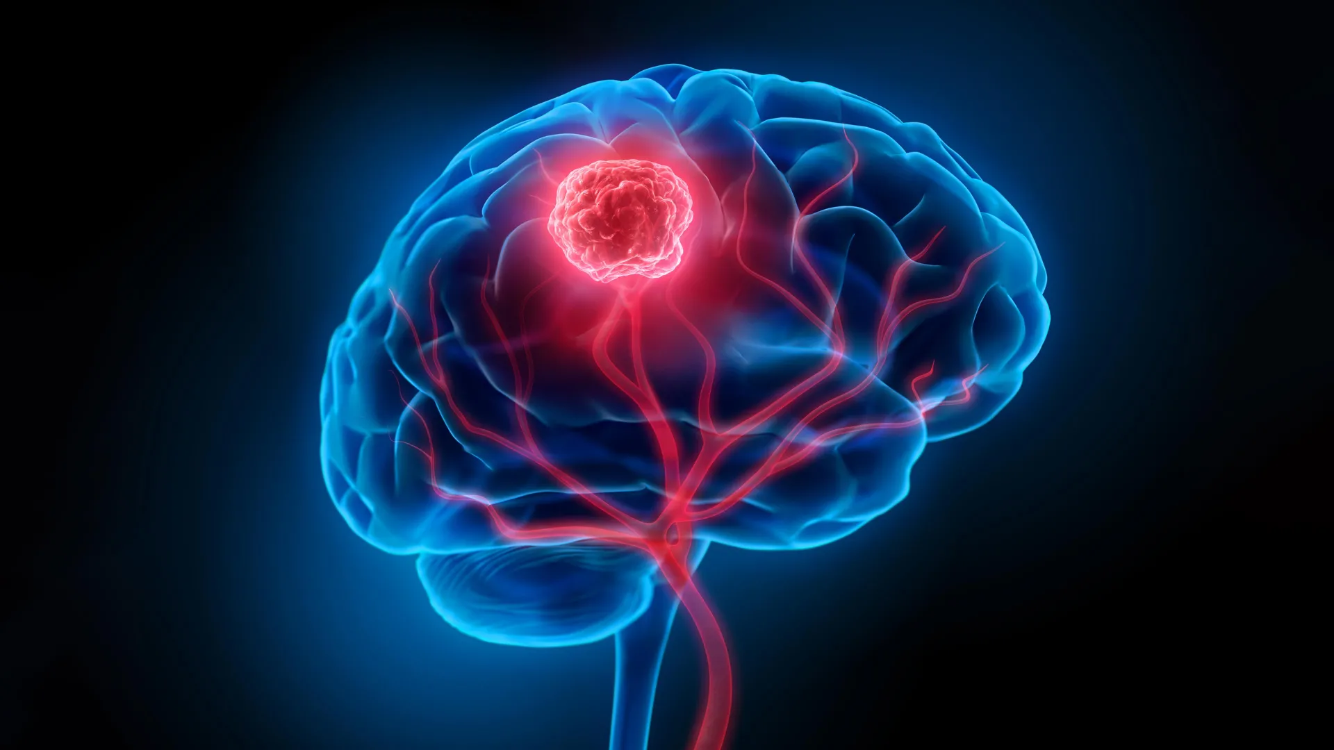 Brain Cancer Breakthrough Supplement Mix Shows Promise World Today Brain Cancer Breakthrough Supplement Mix Shows Promise World Today